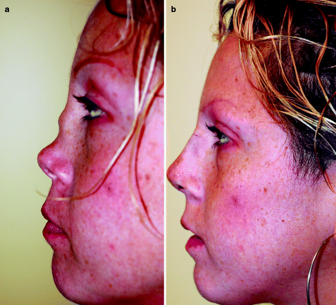 Split Calvarial Bone Grafting in Rhinoplasty | SpringerLink