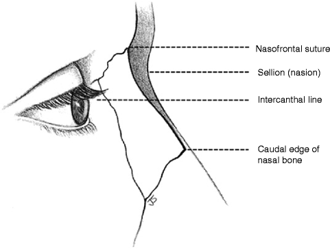 Surgical Anatomy of the Nose | SpringerLink