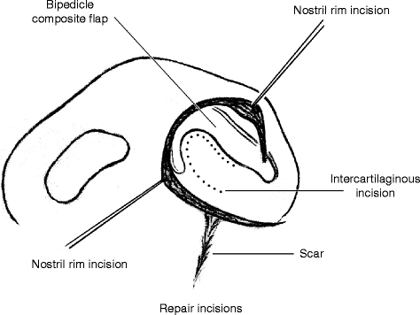 Secondary Cleft Rhinoplasty: Combining an Open Rhinoplasty with the ...