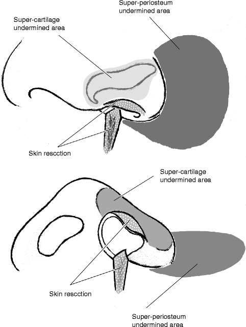 Secondary Cleft Rhinoplasty: Combining an Open Rhinoplasty with the ...
