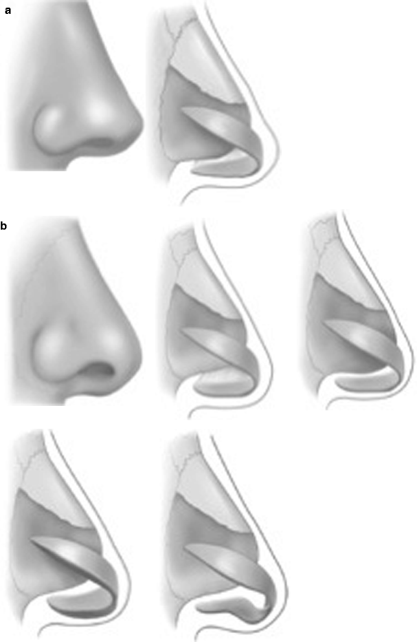 Restoring the Drooping Tip and Hanging Columella in Revision ...