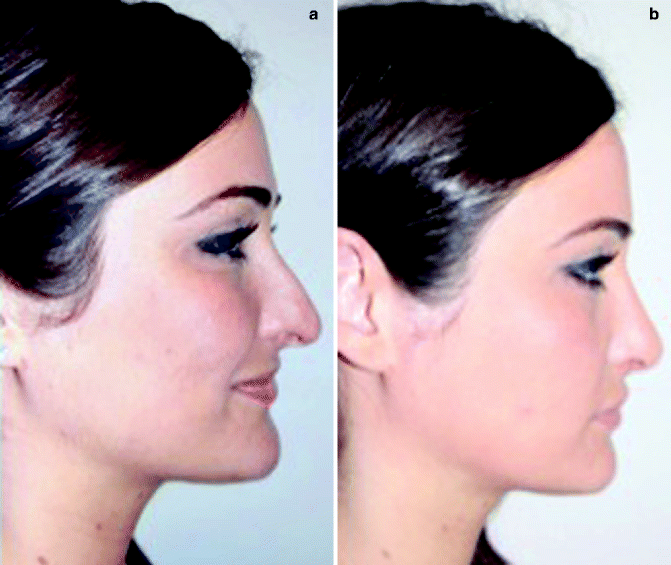 Restoring the Drooping Tip and Hanging Columella in Revision ...