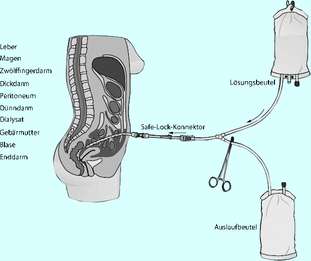Nierenersatzverfahren | SpringerLink