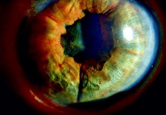 Angle Closure and Glaucoma | SpringerLink