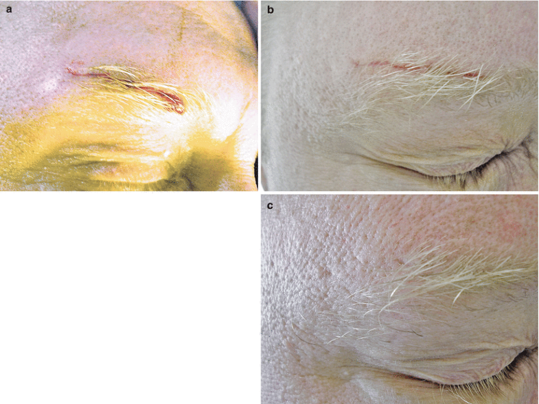 Normotrophic Scars | SpringerLink