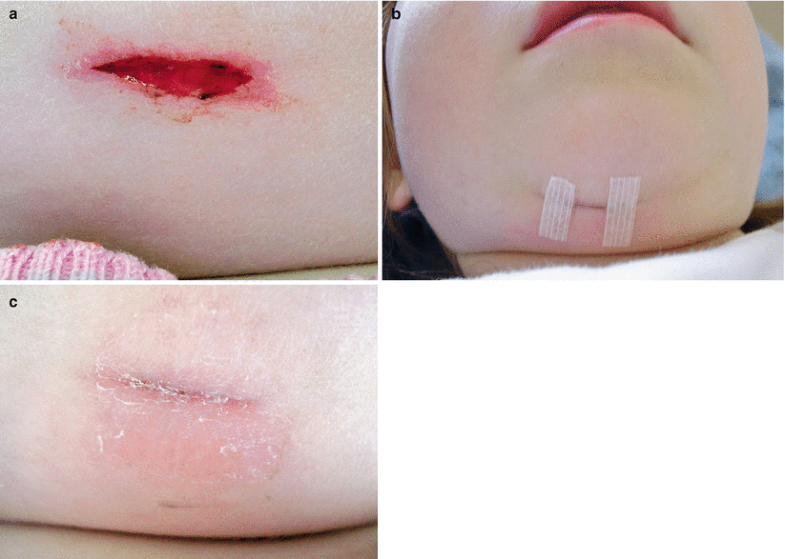 Normotrophic Scars | SpringerLink