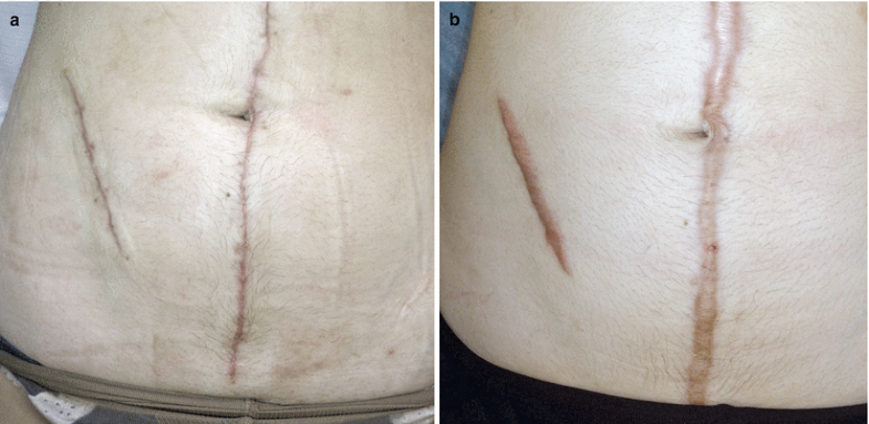 Normotrophic Scars | SpringerLink