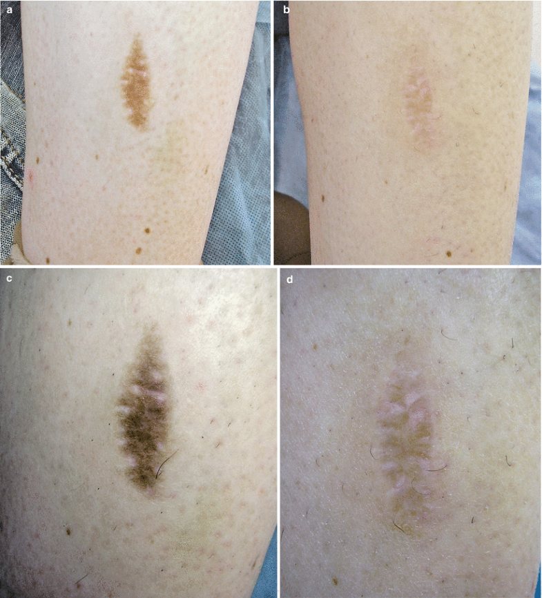 Normotrophic Scars | SpringerLink