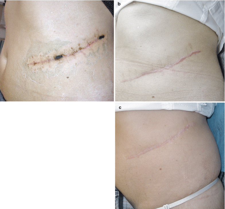 Normotrophic Scars | SpringerLink