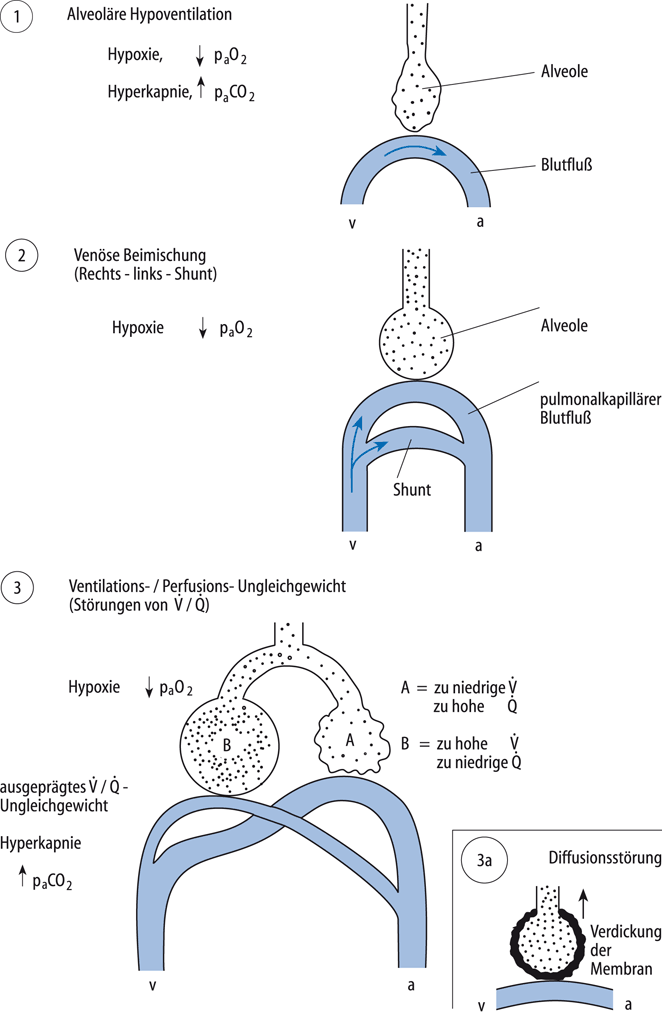 Respiratorische Insuffizienz – Allgemeine Pathophysiologie | SpringerLink