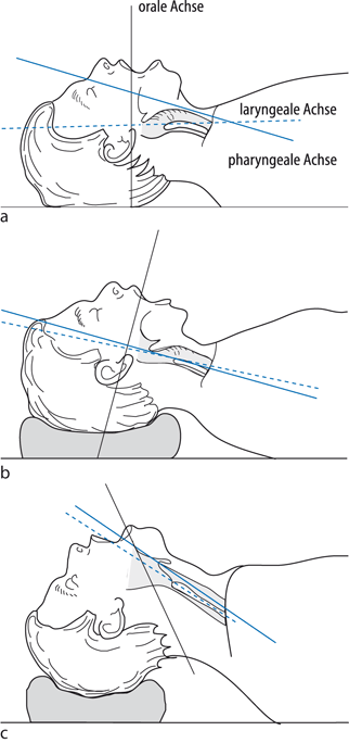 Endotracheale Intubation | SpringerLink