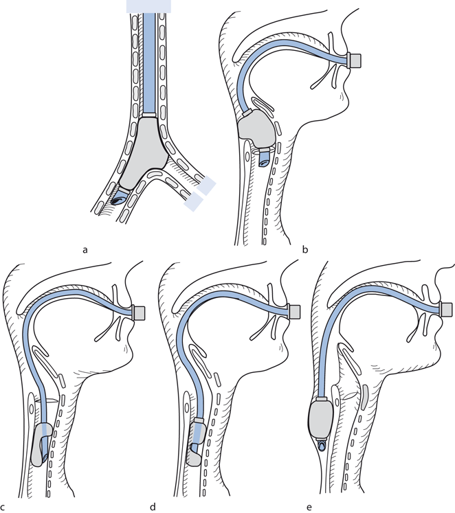 Endotracheale Intubation | SpringerLink