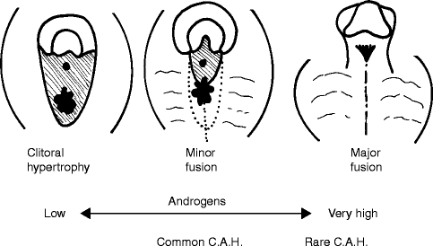 Ambiguous Genitalia: Is It a Boy or a Girl? | SpringerLink