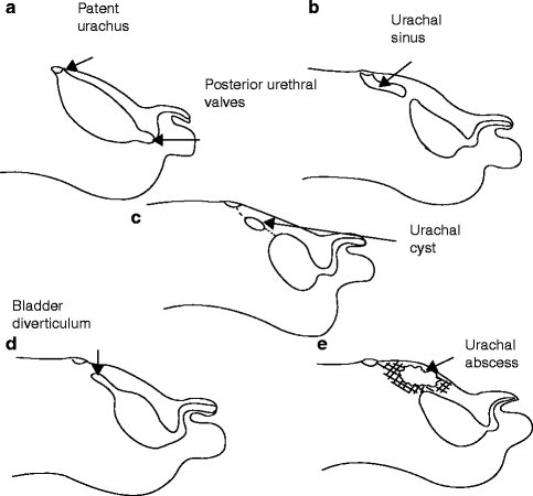 The Umbilicus | SpringerLink
