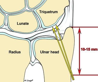 DRUJ Instability: Arthroscopic Repair of the Detached TFCC to the Fovea ...