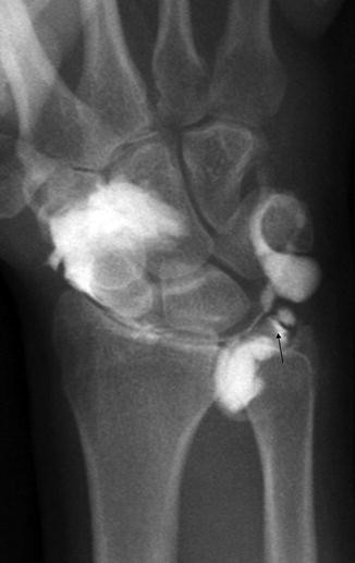DRUJ Instability: Arthroscopic Repair of the Detached TFCC to the Fovea ...