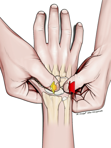 LT Tears and Arthroscopic Repair | SpringerLink