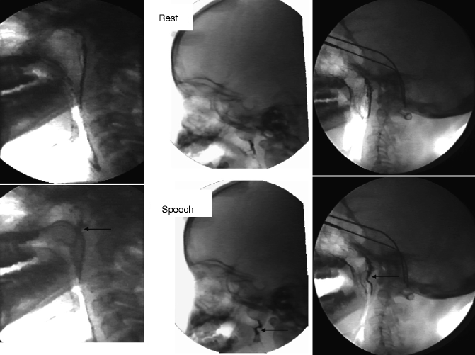 The Velopharyngeal Mechanism | SpringerLink