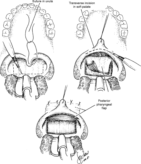 Surgical Management of Velopharyngeal Dysfunction | SpringerLink