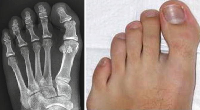 Hallux Interphalangeus | SpringerLink