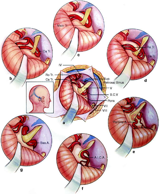 Microsurgical Anatomy of the Cerebellopontine Angle by the Retrosigmoid ...