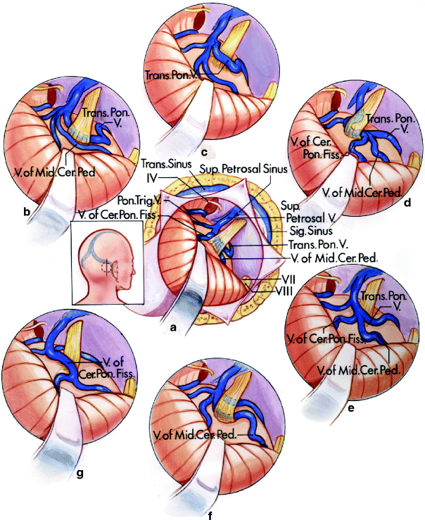 Microsurgical Anatomy of the Cerebellopontine Angle by the Retrosigmoid ...