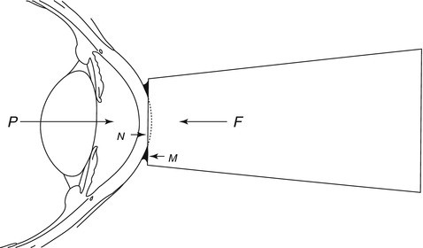 Applanation Tonometry | SpringerLink