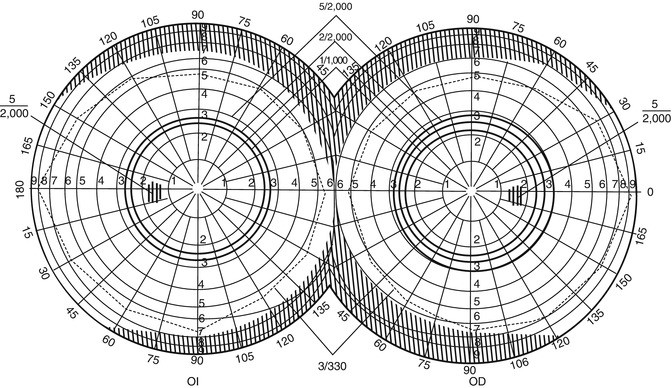 Campimetry and Perimetry | SpringerLink