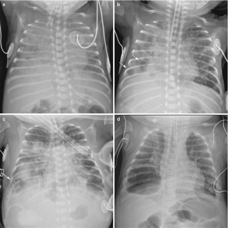 Neonatal Chest Imaging | SpringerLink