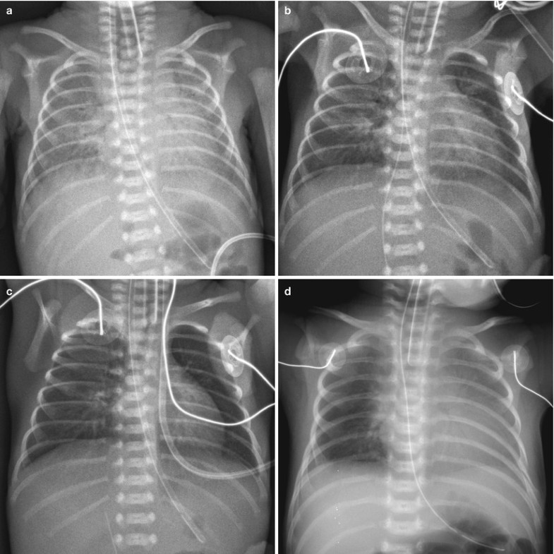 Neonatal Chest Imaging | SpringerLink