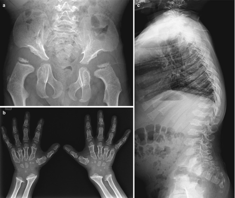 Genetic Skeletal Disorders | SpringerLink