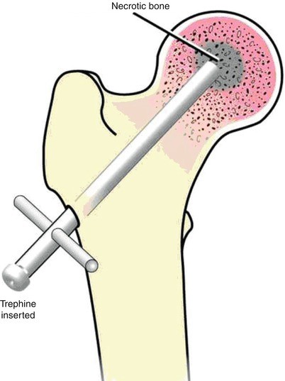 Principles of Core Decompression for Osteonecrosis of the Hip ...