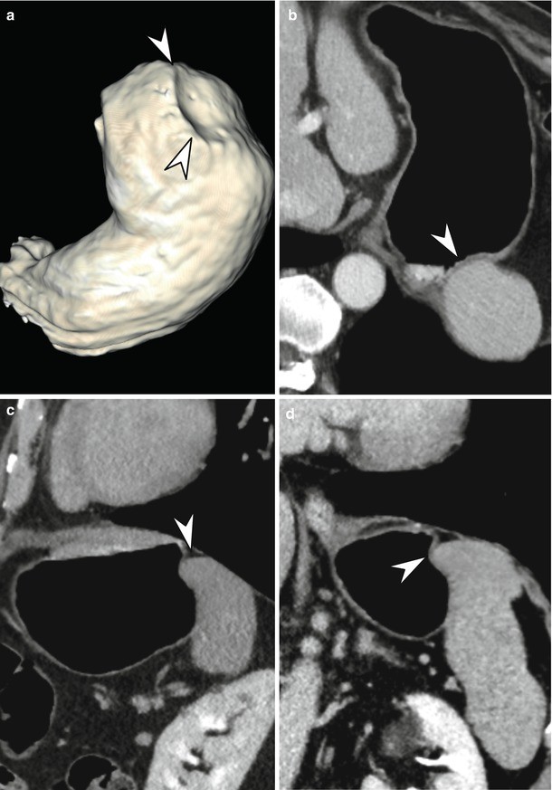 Anomalies and Anatomic Variations of the Spleen | SpringerLink