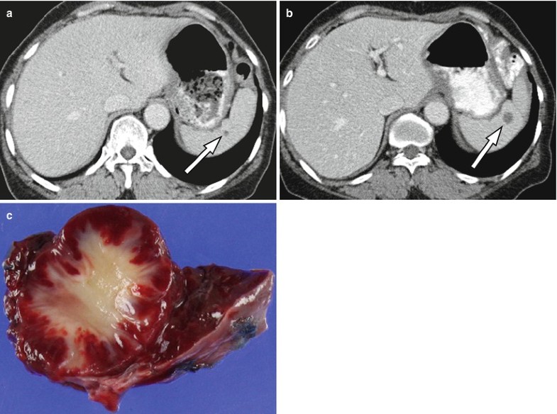 Benign Focal Lesions of the Spleen | SpringerLink