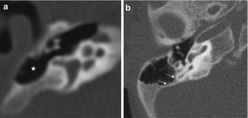 The Mastoid | SpringerLink