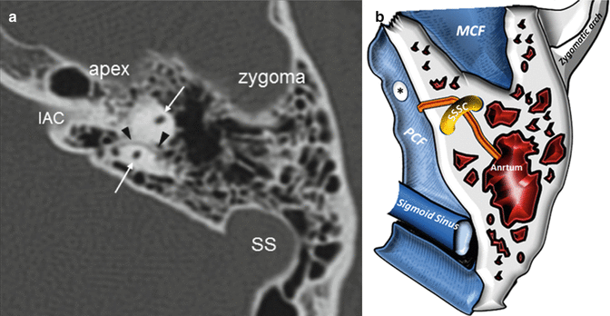 The Mastoid | SpringerLink