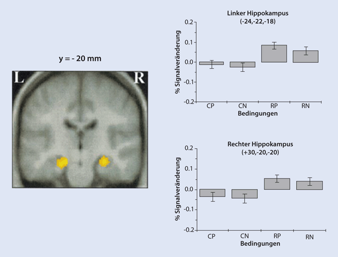 Gedächtnissysteme und Taxonomie von Gedächtnisstörungen | SpringerLink