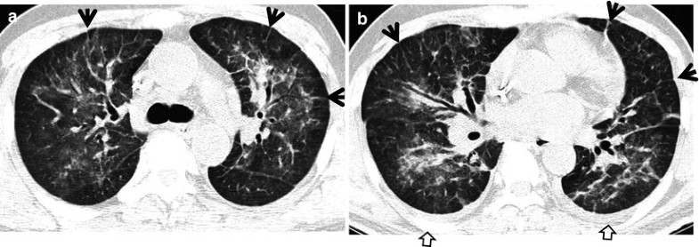 Interlobular Septal Thickening | SpringerLink