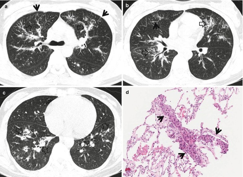 Interlobular Septal Thickening | SpringerLink