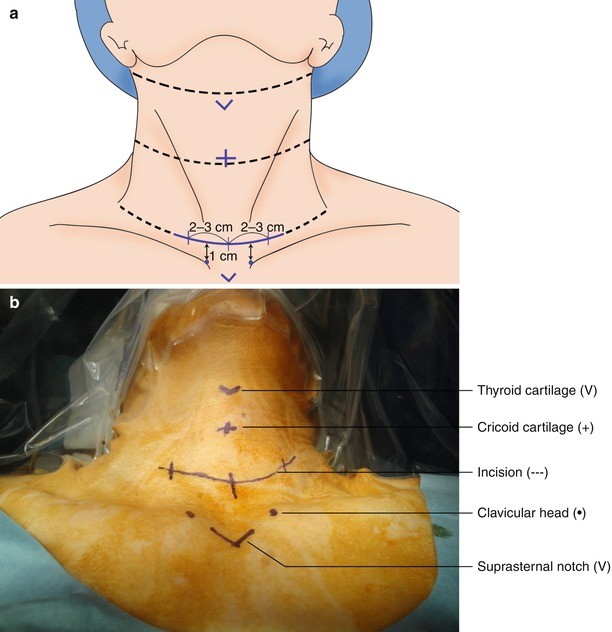 Open Thyroidectomy | SpringerLink