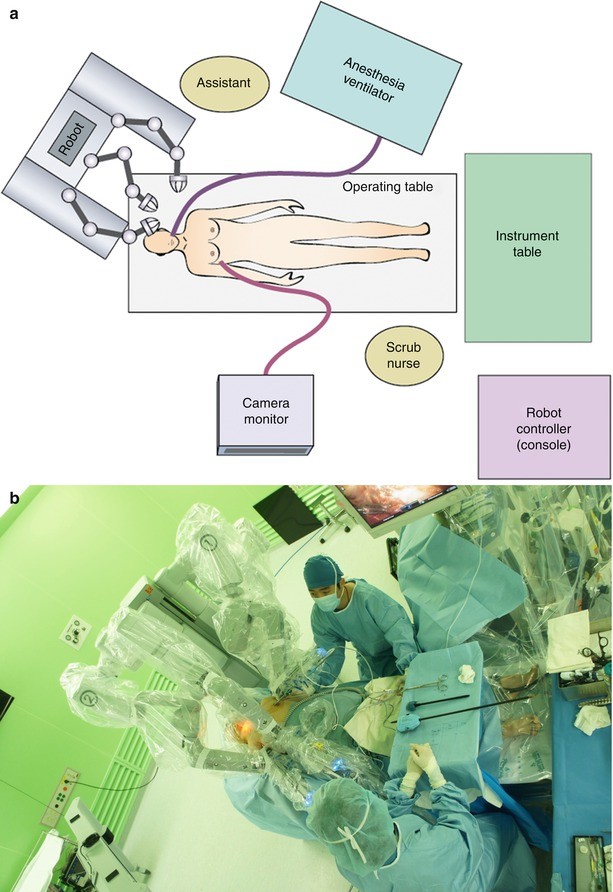 Robotic Thyroidectomy: Bilateral Axillo-Breast Approach (BABA) | SpringerLink