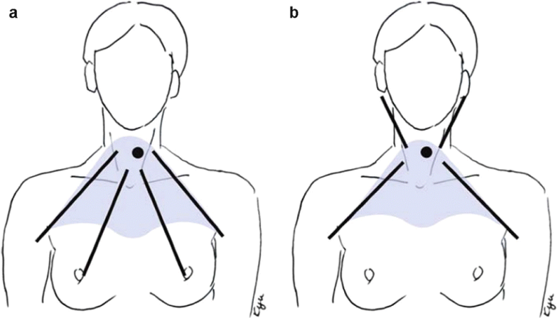 Robotic Thyroidectomy: Bilateral Axillo-Postauricular Approach (BAPA ...