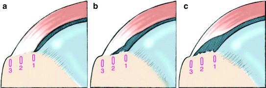 A Review of Rotator Cuff Classifications in Current Use | SpringerLink
