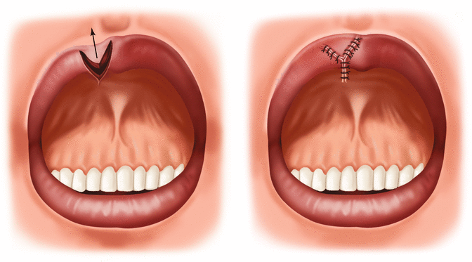 Reconstruction of Complex Lip Defects | SpringerLink
