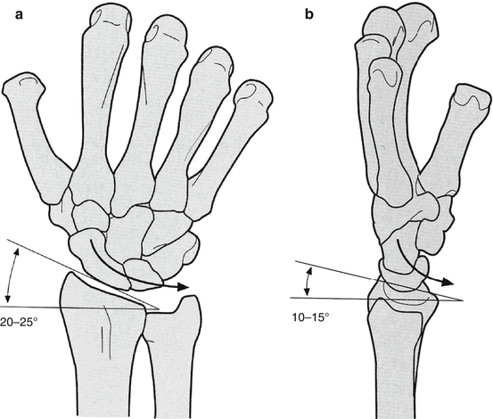 Distal Radius Fractures | SpringerLink