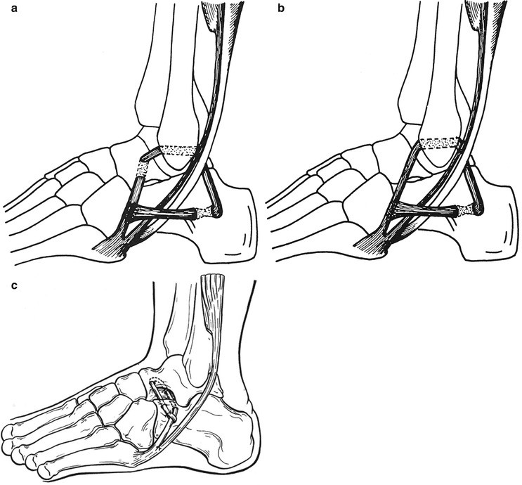 Foot and Ankle Injuries | SpringerLink
