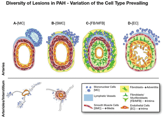 Pulmonary Hypertension: Pathology | SpringerLink