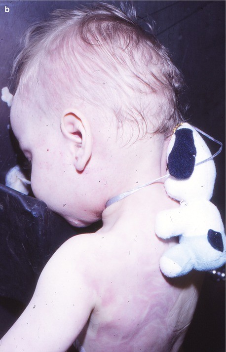 Asphyxia | SpringerLink