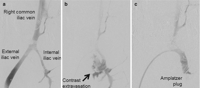 Iliac Vein Injuries | SpringerLink