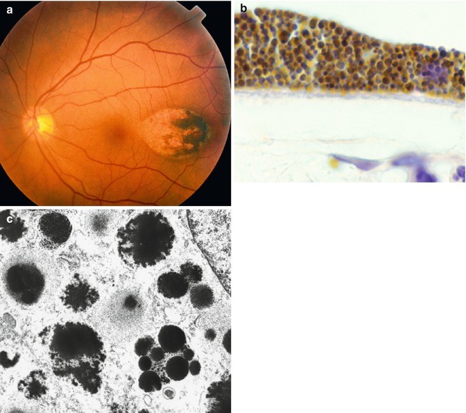 Retinal Pigment Epithelial Tumors | SpringerLink